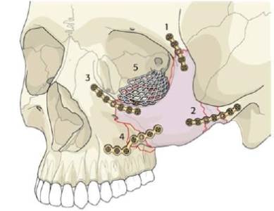 Panorama geral sobre as fraturas de órbita – Anatomia & Fisioterapia
