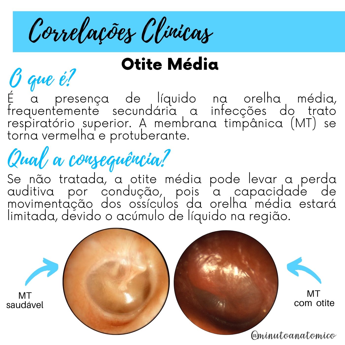 Minuto Anatômico #20: Ossículos da Audição – Anatomia & Fisioterapia