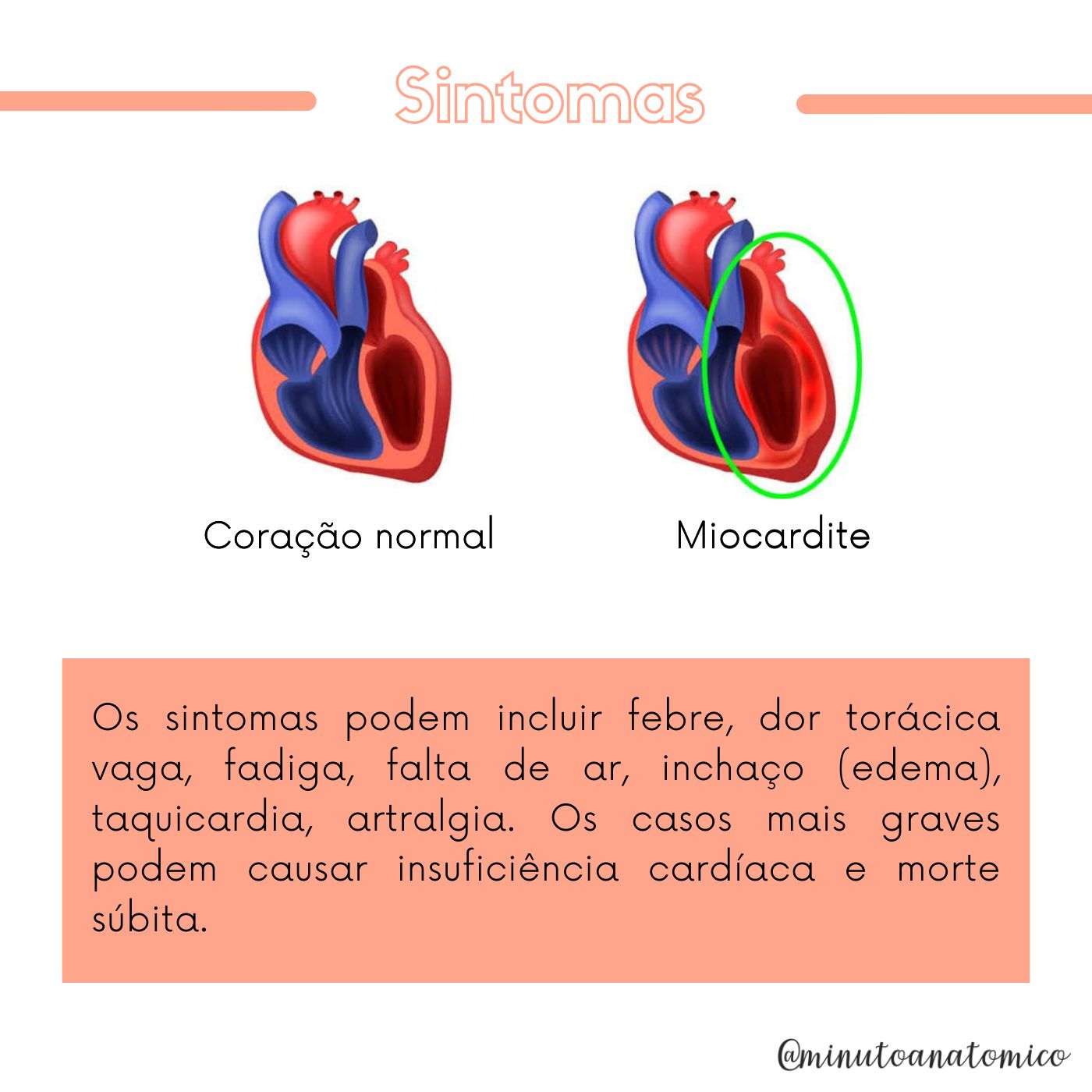 Minuto Anatomoclínico #31: Miocardite – Anatomia & Fisioterapia
