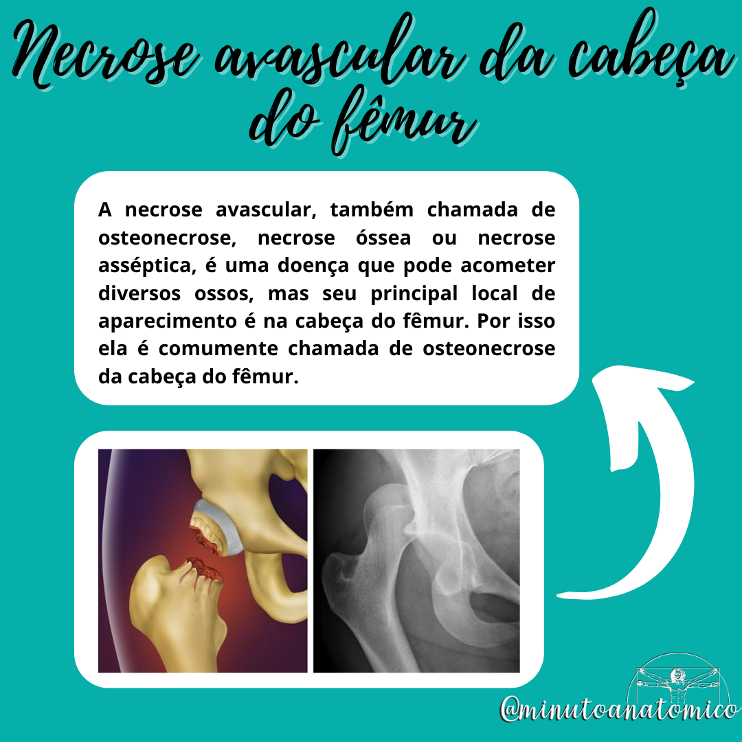 Minuto Anatomoclínico #55: Necrose avascular da cabeça do femur ...