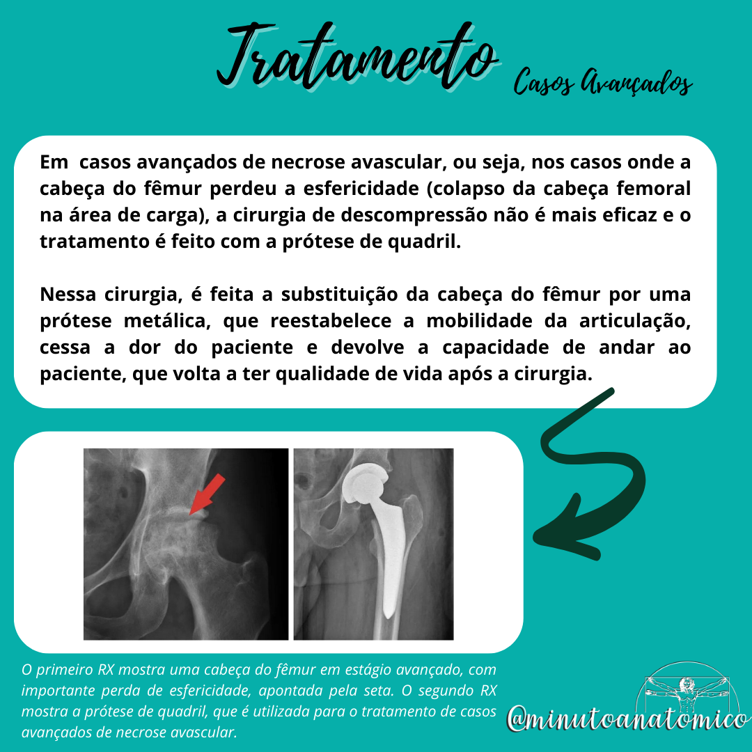 Minuto Anatomoclínico #55: Necrose avascular da cabeça do femur ...
