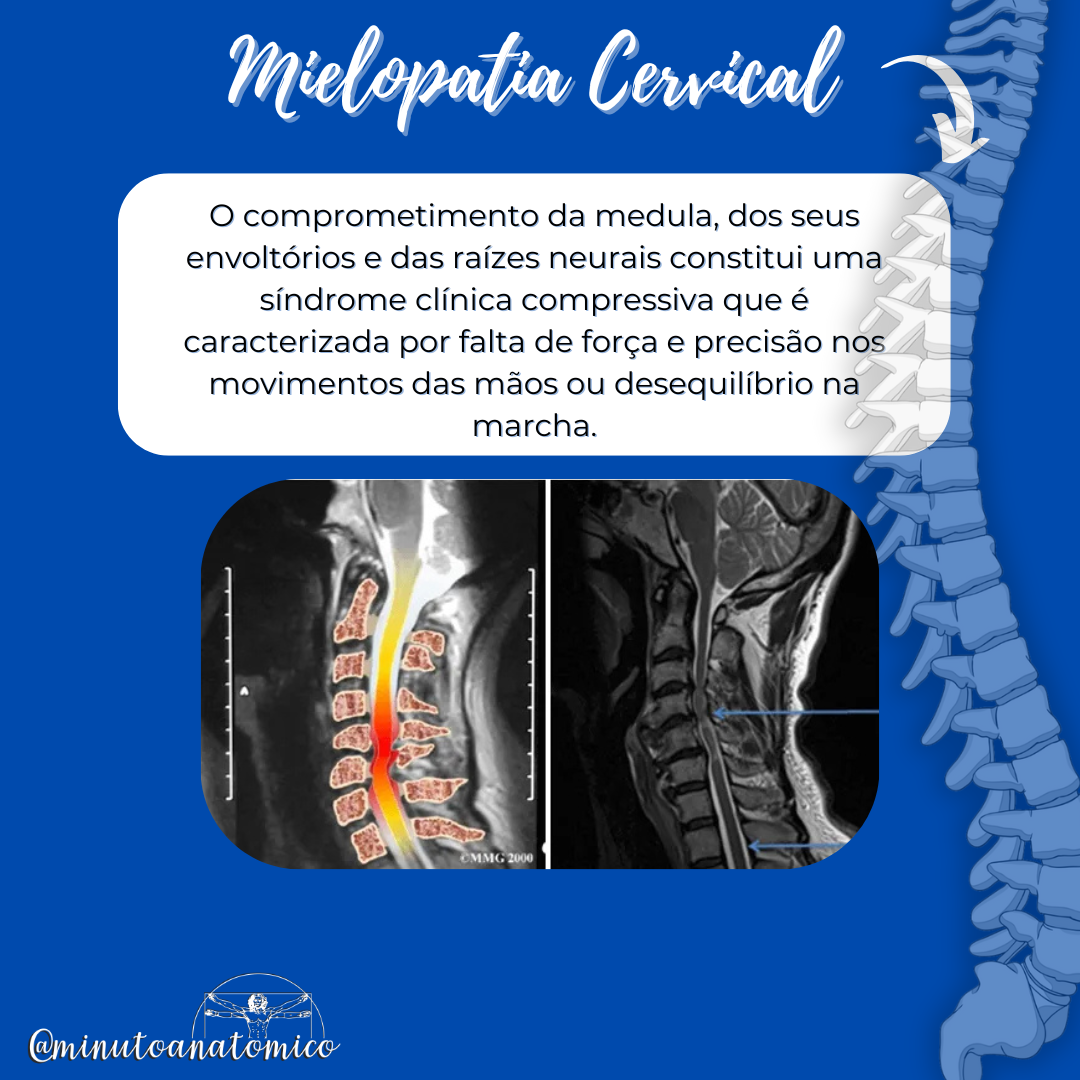 Minuto Anatomoclínico #59: Mielopatia cervical – Anatomia & Fisioterapia