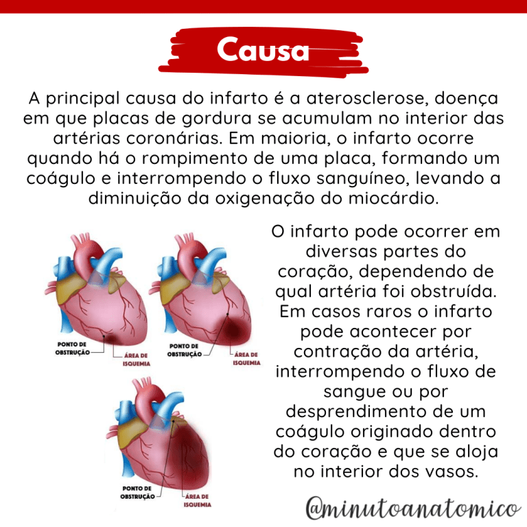 Minuto Anatomoclínico #65: Infarto agudo do miocárdio – Anatomia ...