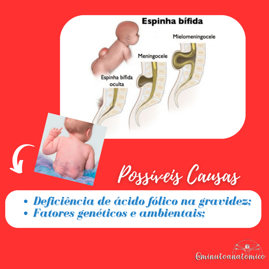 Minuto Anatomoclínico #73: Espinha bífida – Anatomia & Fisioterapia