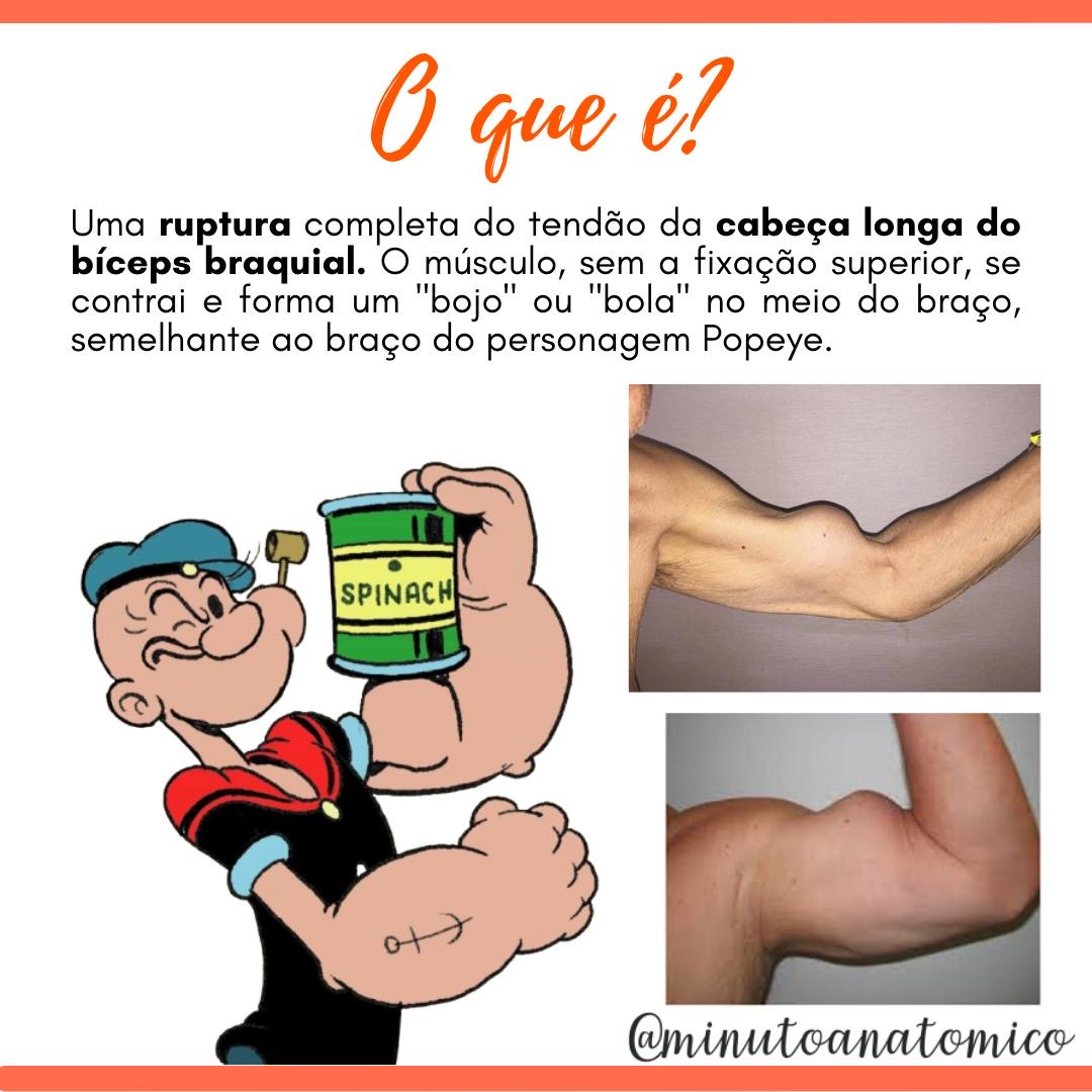 Minuto Anatomoclínico #93: Sinal do Popeye – Anatomia & Fisioterapia