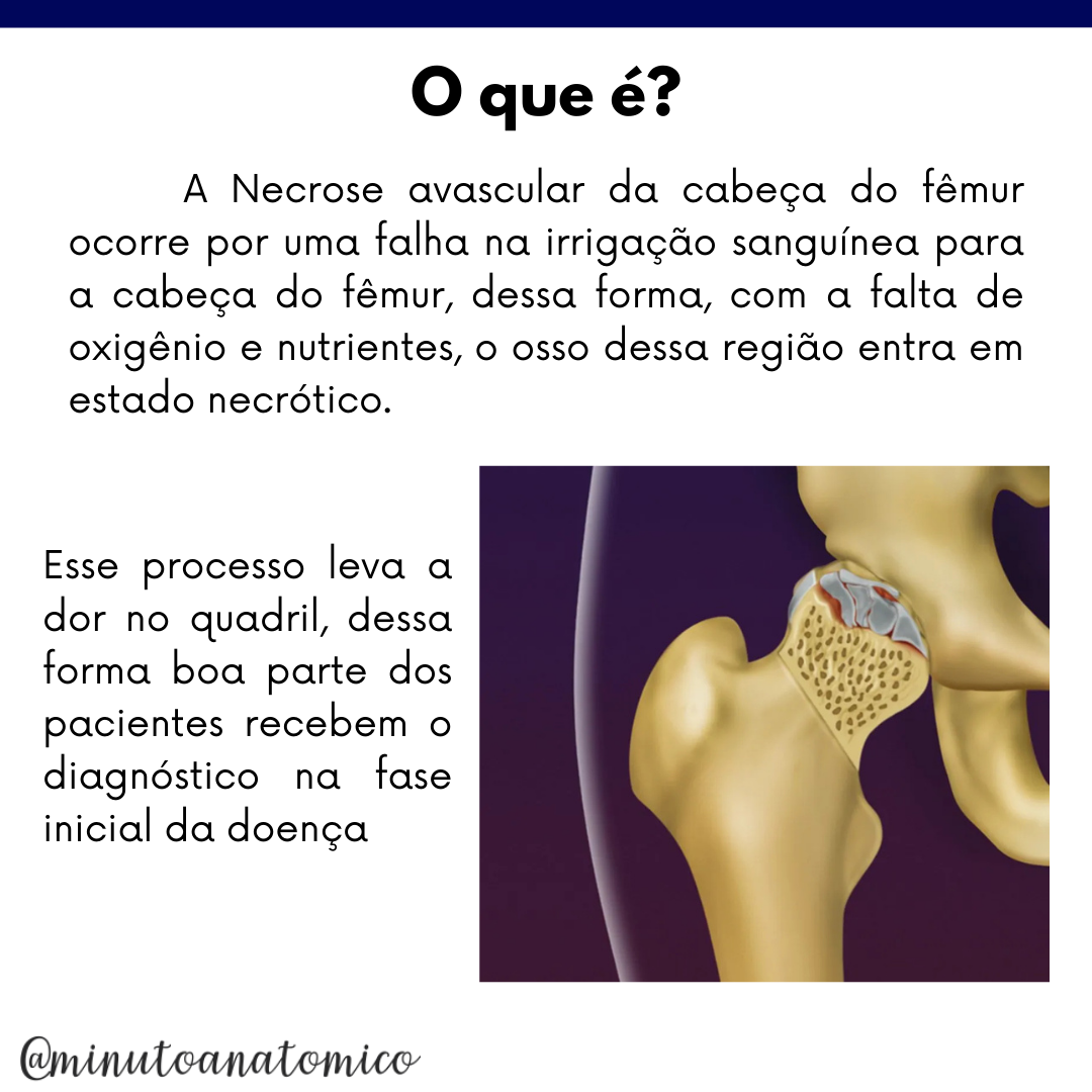 Minuto Anatomoclínico #95: Necrose avascular da cabeça do fêmur ...