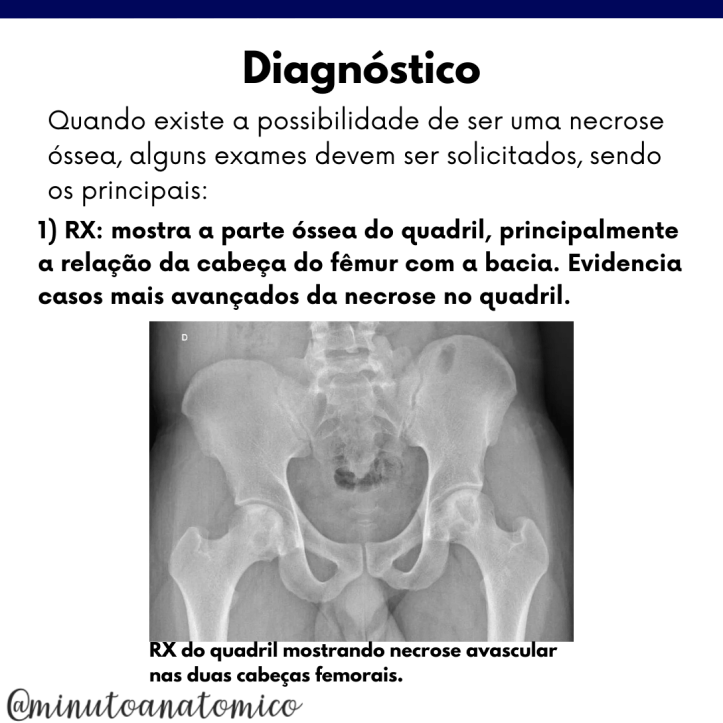 Minuto Anatomoclínico #95: Necrose avascular da cabeça do fêmur ...