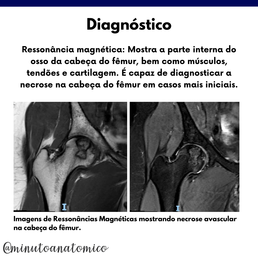 Minuto Anatomoclínico #95: Necrose avascular da cabeça do fêmur ...